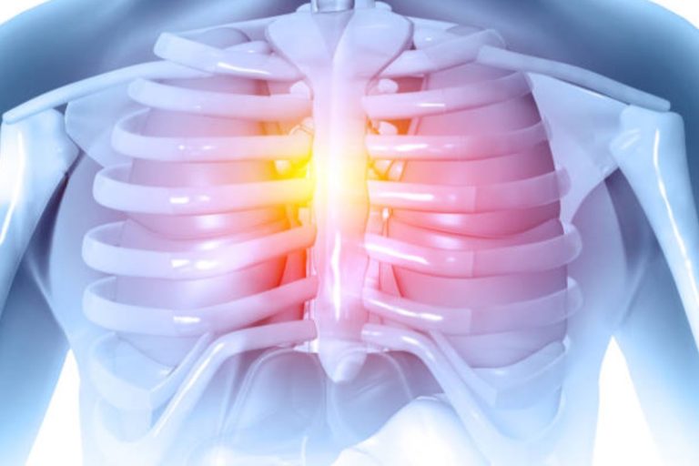 Bruised Sternum: Causes and How to Treat Them