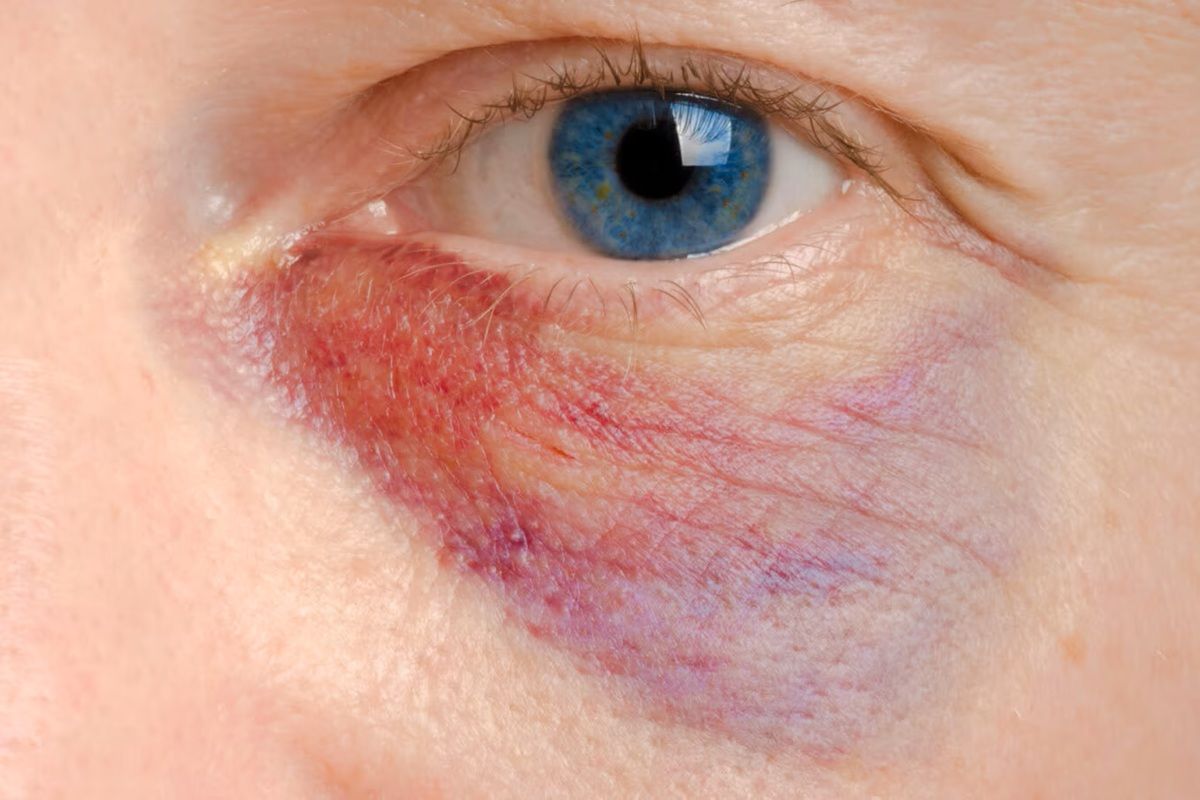 How To Get Rid of a Black Eye – 22 Most Handy Tips To Learn